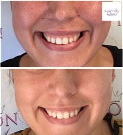 Gummy Smile | Injection Queen