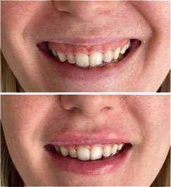 Gummy Smile | Injection Queen