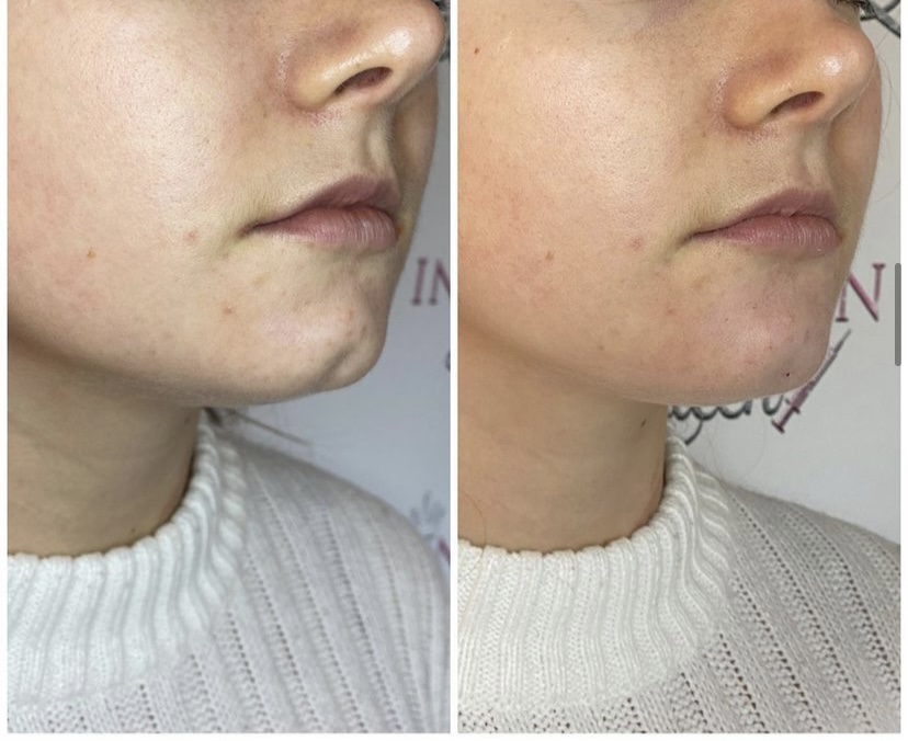 Chin Filler | Injection Queen