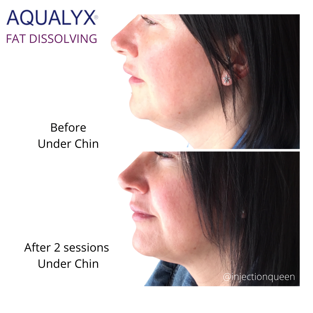Fat Dissolving Injections | Injection Queen