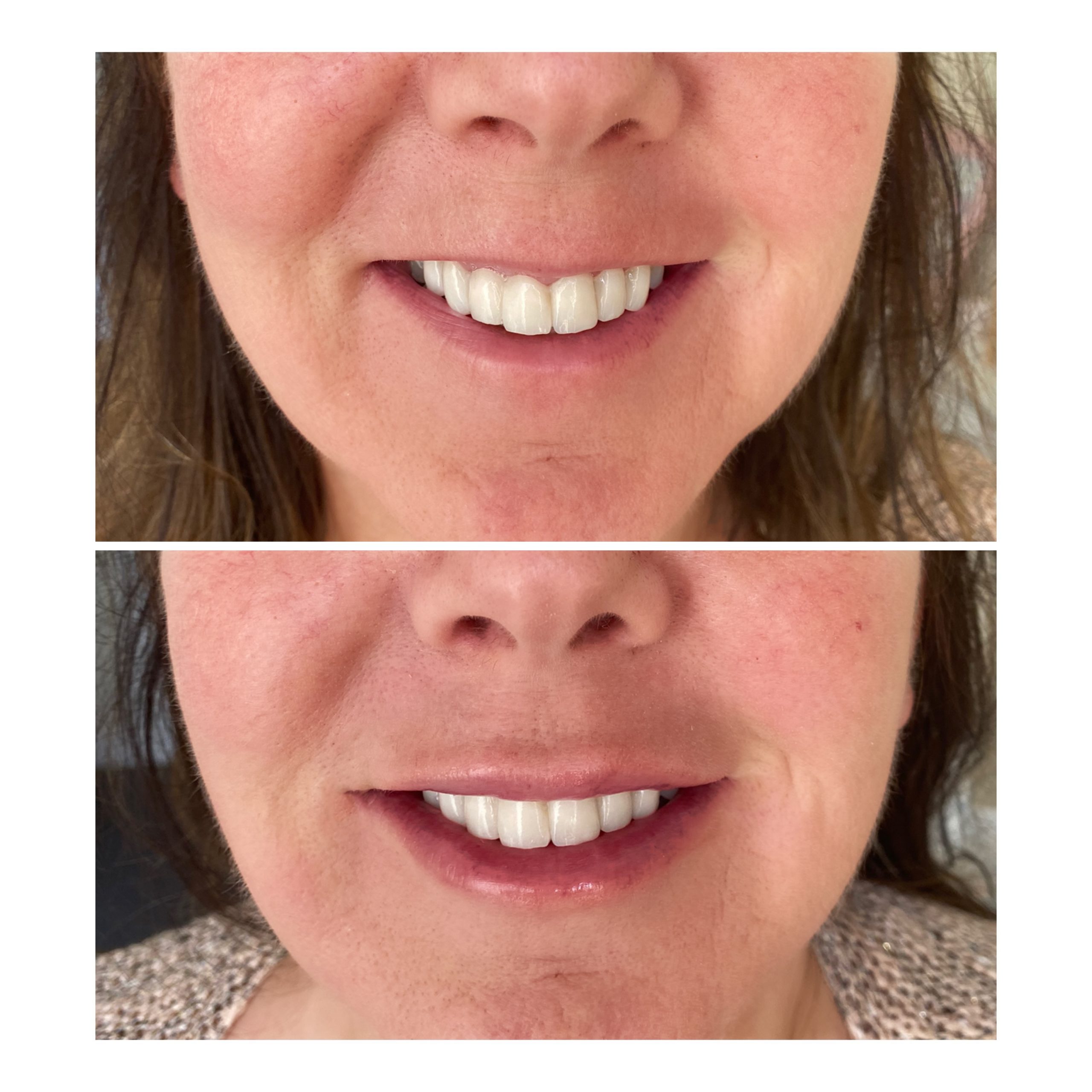 Gummy Smile | Injection Queen