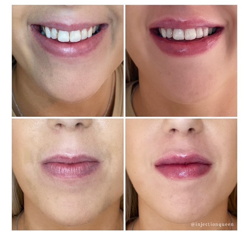 Gummy Smile | Injection Queen