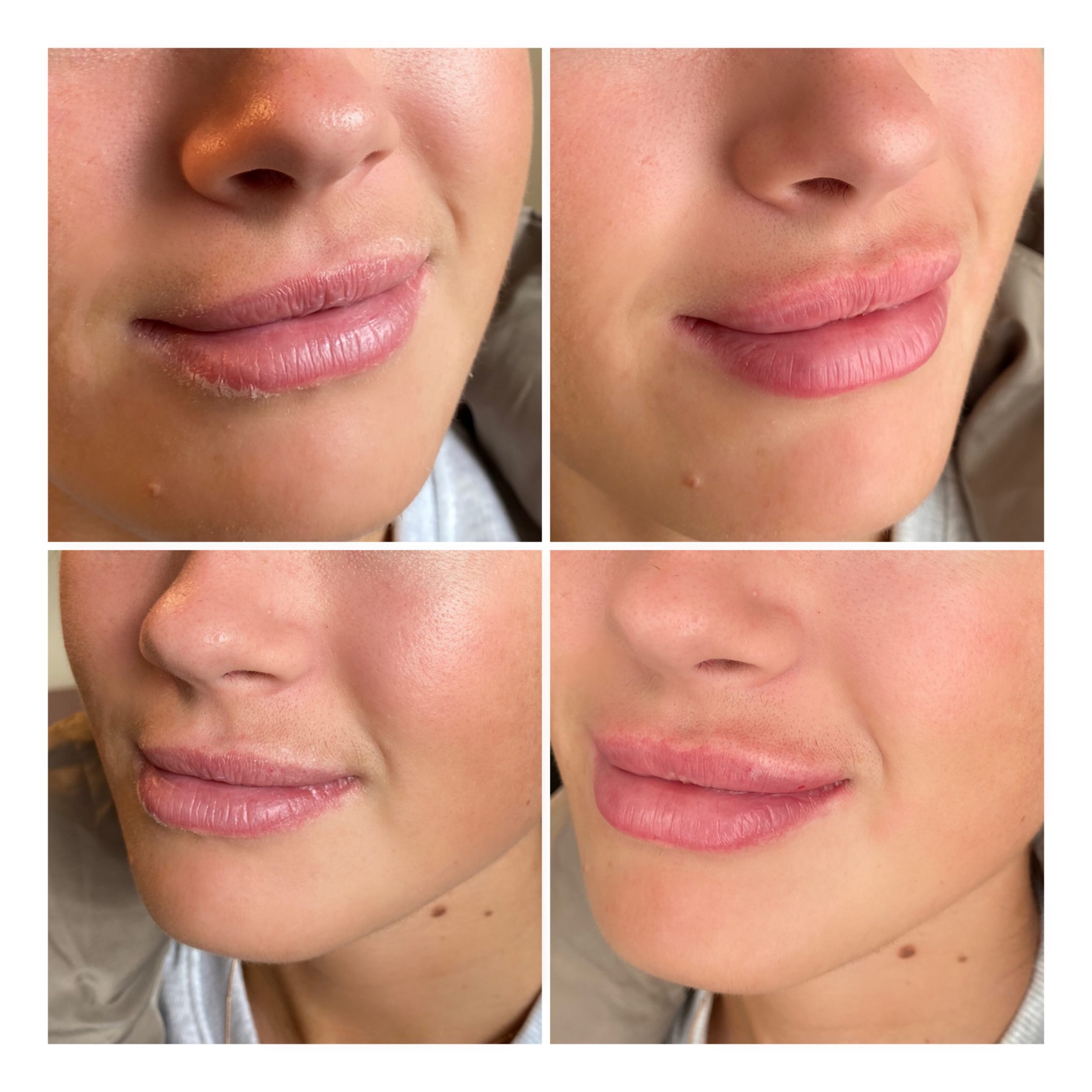 Lip Filler | Injection Queen