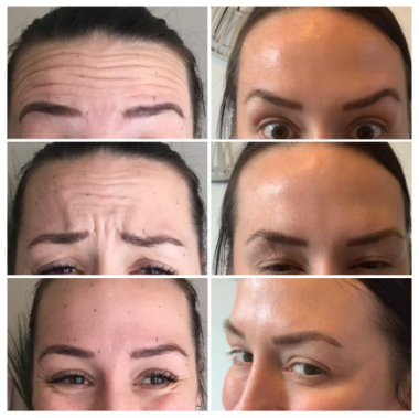 Forehead Lines | Injection Queen